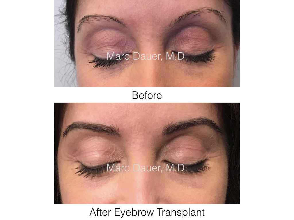 Eyebrow Transplant Photos | Los Angeles Eyebrow Transplantation