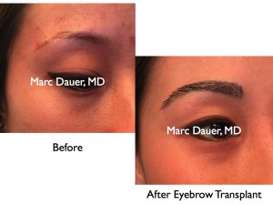 Amazing Eyebrow Transplant | Marc Dauer, MD Hair Transplant Doctor Los ...