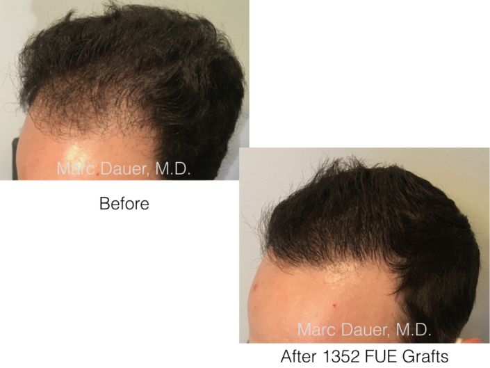 Hair Restoration Blog, Hair Transplant Surgeon Los Angeles - Marc Dauer, MD