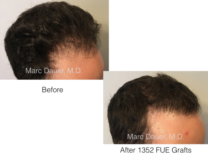 Hair Restoration Blog, Hair Transplant Surgeon Los Angeles - Marc Dauer, MD