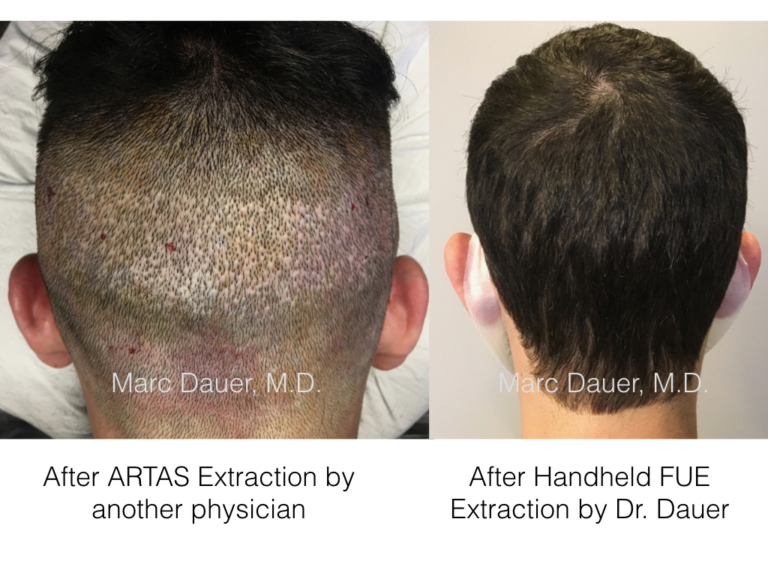 Hair Restoration Blog, Hair Transplant Surgeon Los Angeles - Marc Dauer, MD